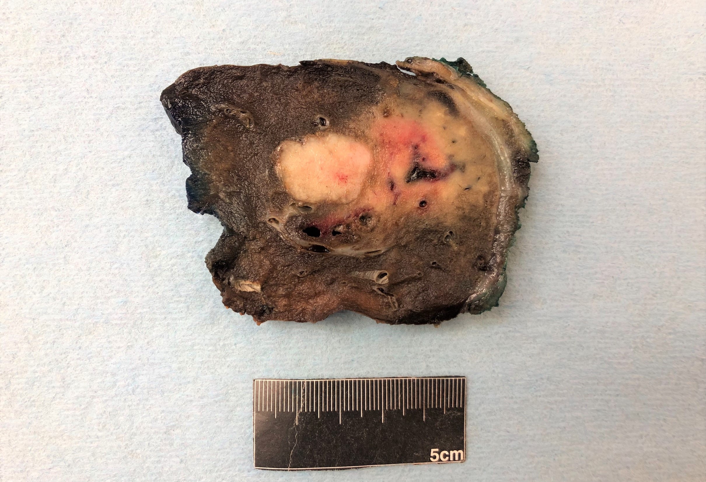 Non-keratinizing squamous cell carcinoma of the lung | MyPathologyReport.ca