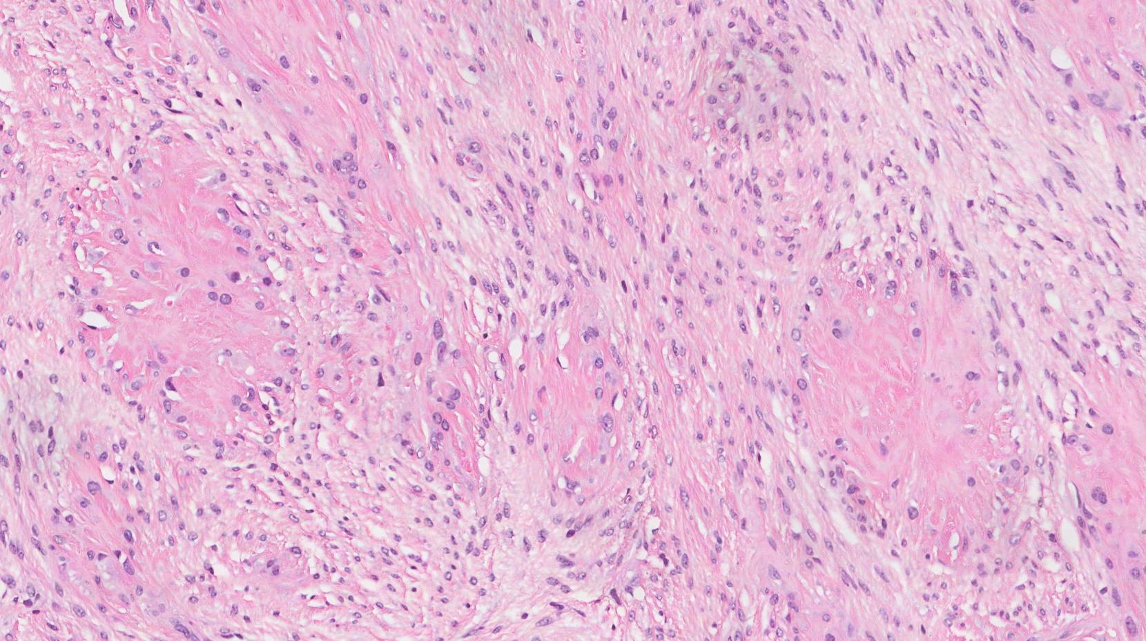 Low grade fibromyxoid sarcoma | MyPathologyReport