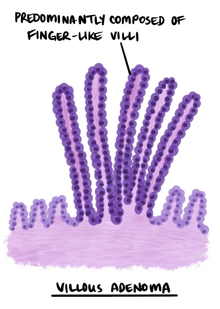 Villous adenoma of the colon and rectum | MyPathologyReport
