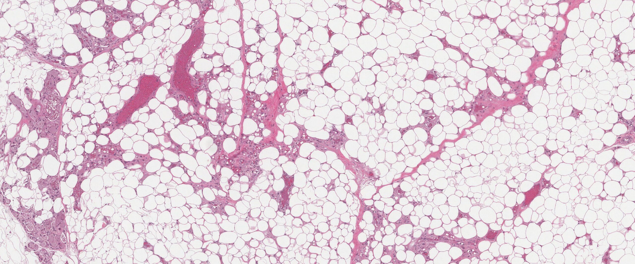 Vaše patološko poročilo za angiolipom | MyPathologyReport