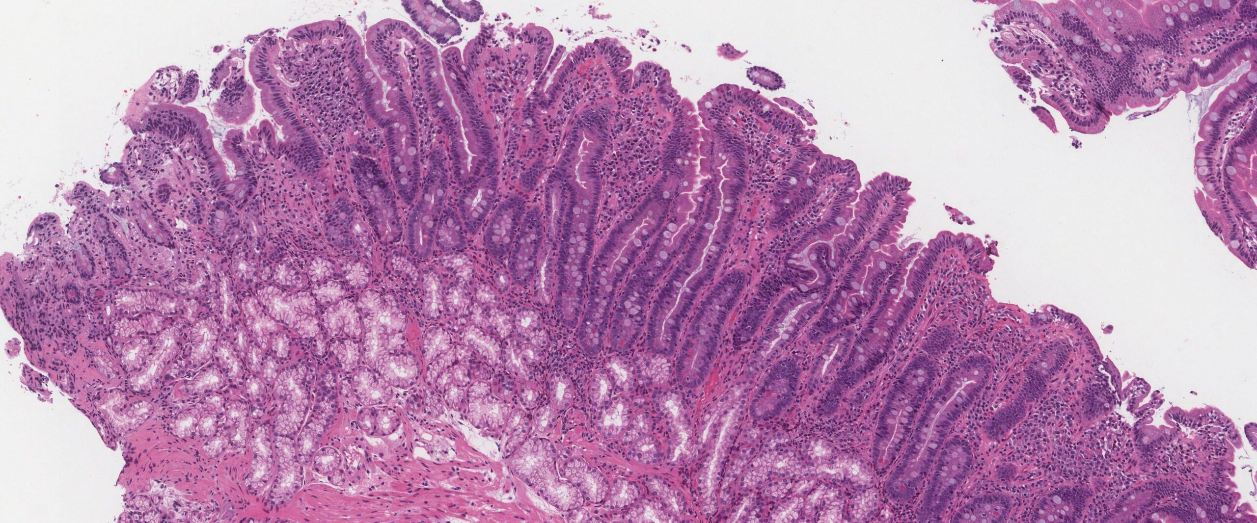 Celiac disease | MyPathologyReport