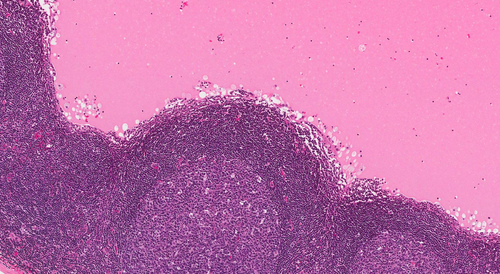 Torbiel Limfoepitelialna Mypathologyreport Ca