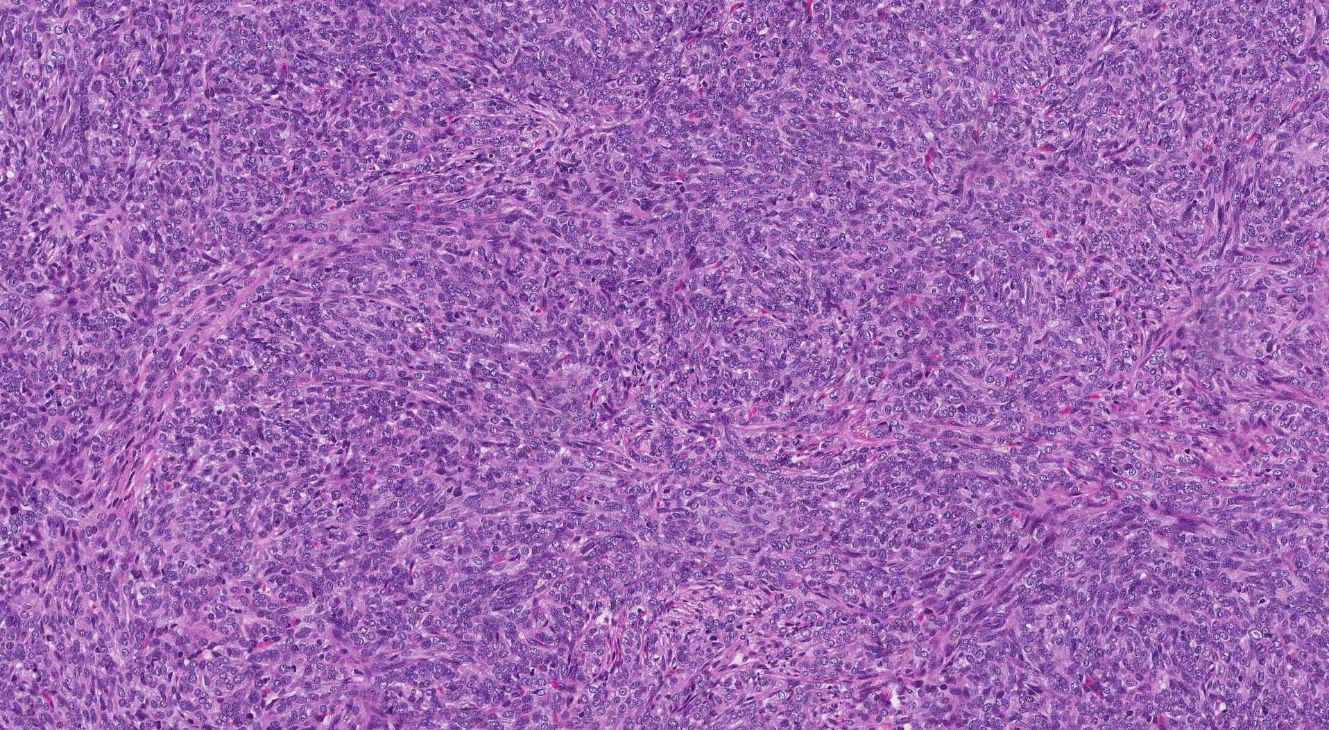 A 型胸腺腫 Mypathologyreportca