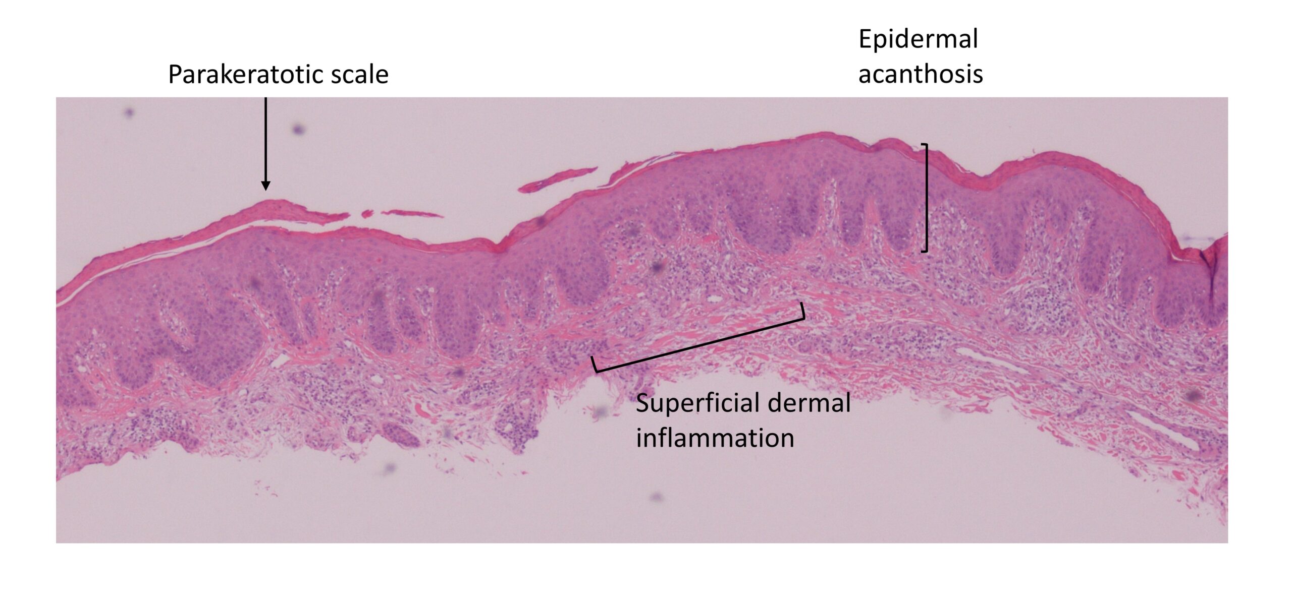 Vaša patologická správa o psoriaziformnej dermatitíde | MyPathologyReport