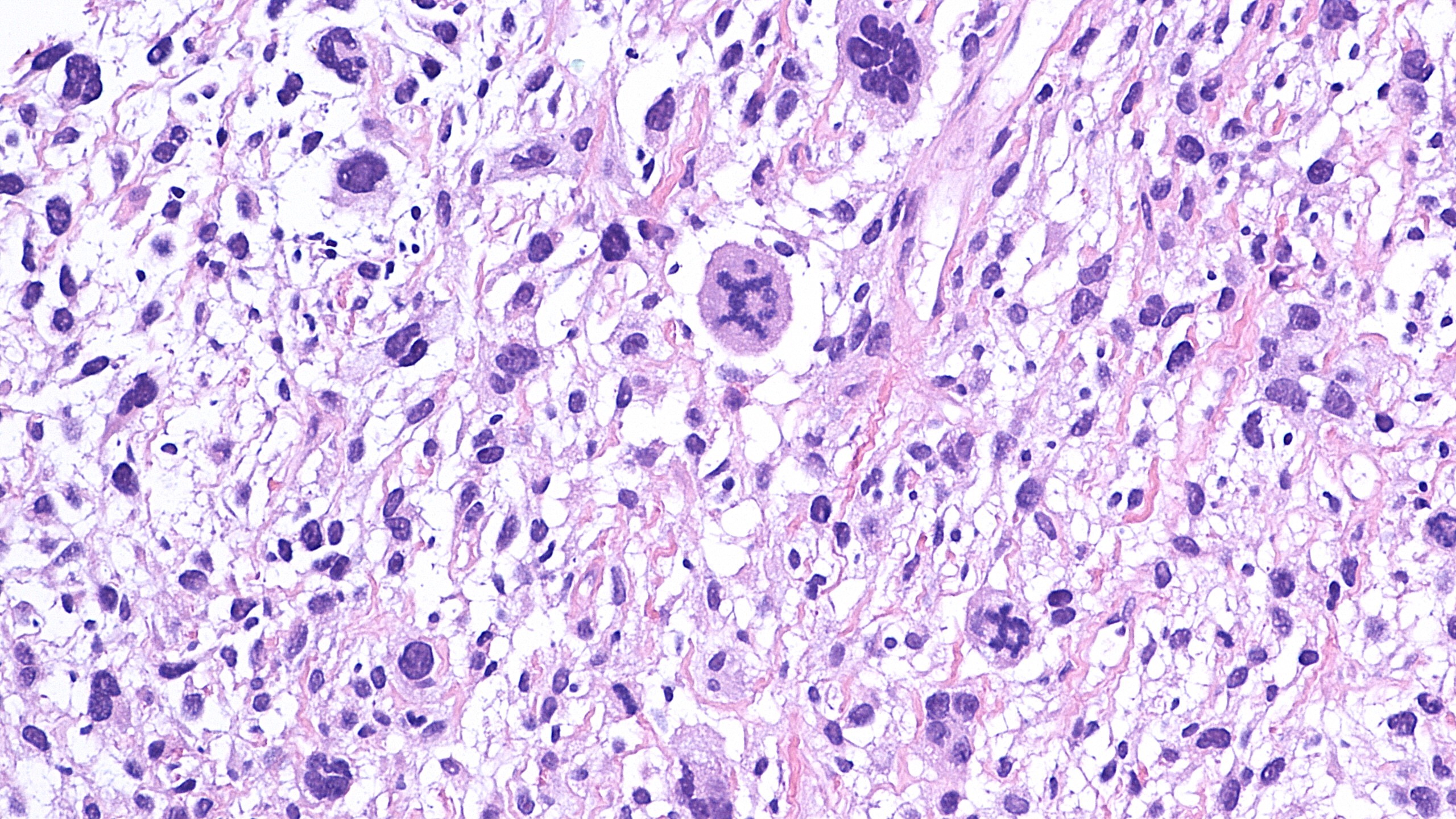 Kwaadaardige neoplasie | MyPathologyReport