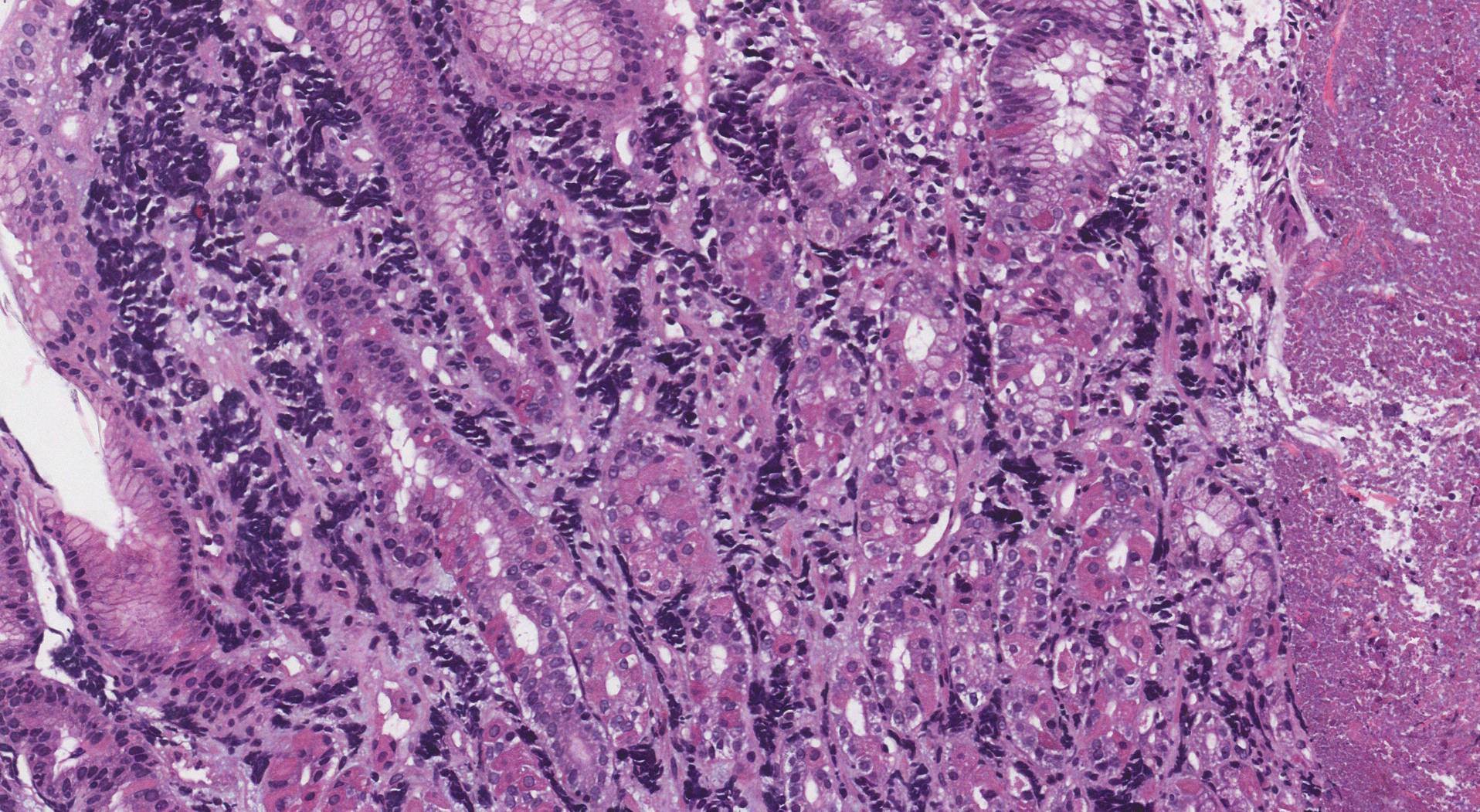 Slecht Weefsel Basaalcelcarcinoom / DermaTeam