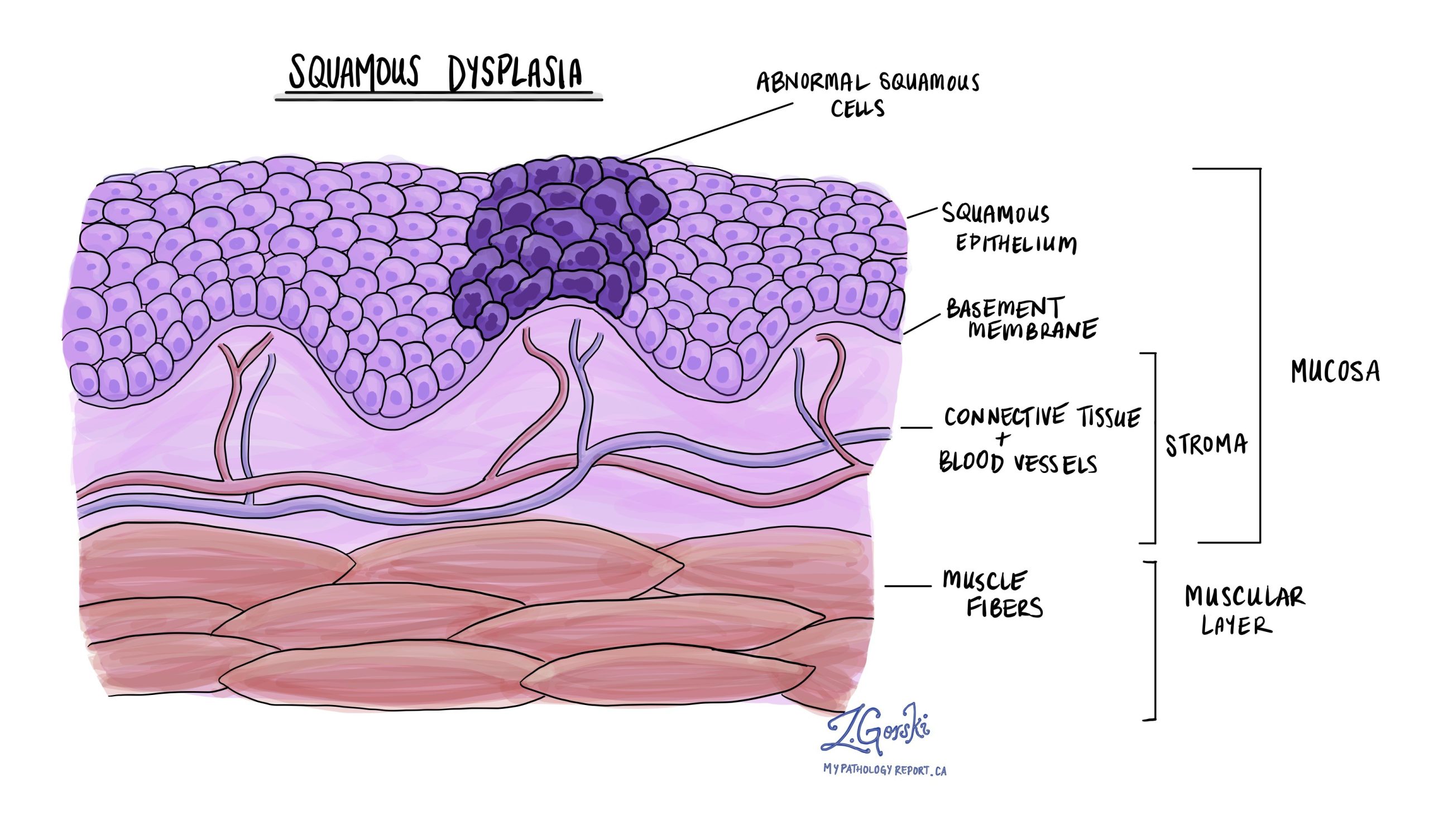 ¿Qué es la displasia escamosa? | MyPathologyReport