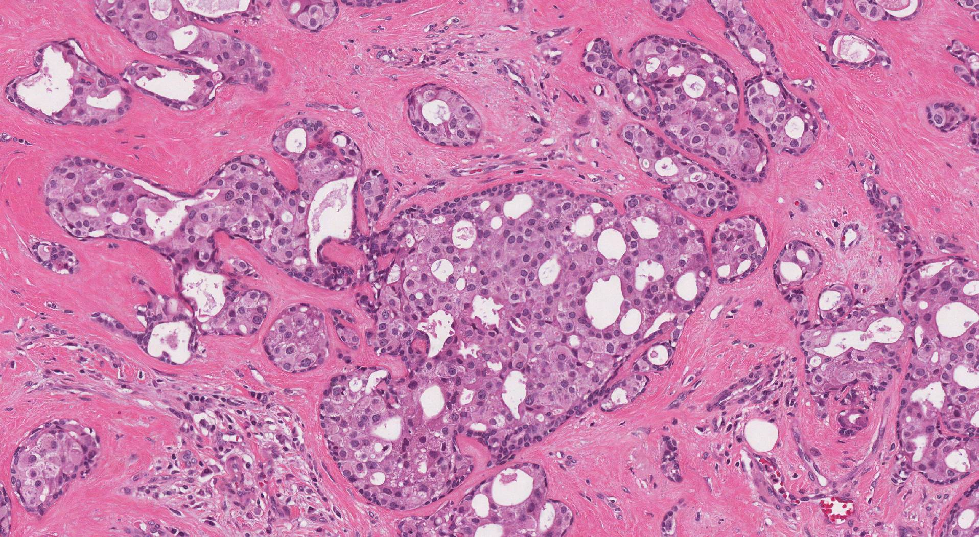 Tlaleho ea hau ea pathology bakeng sa intraductal carcinoma ea ...